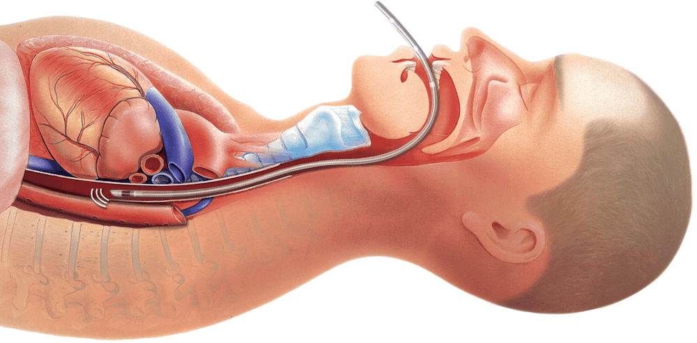 Probe Placement – Deltex Academy